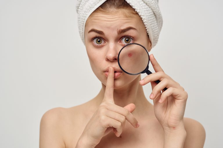 Akne oziroma mozolji so po vsej verjetnosti ena od najbolj pogostih ...